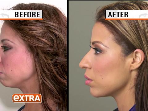 The Facelift That’s Breaking All the Rules | ExtraTV.com